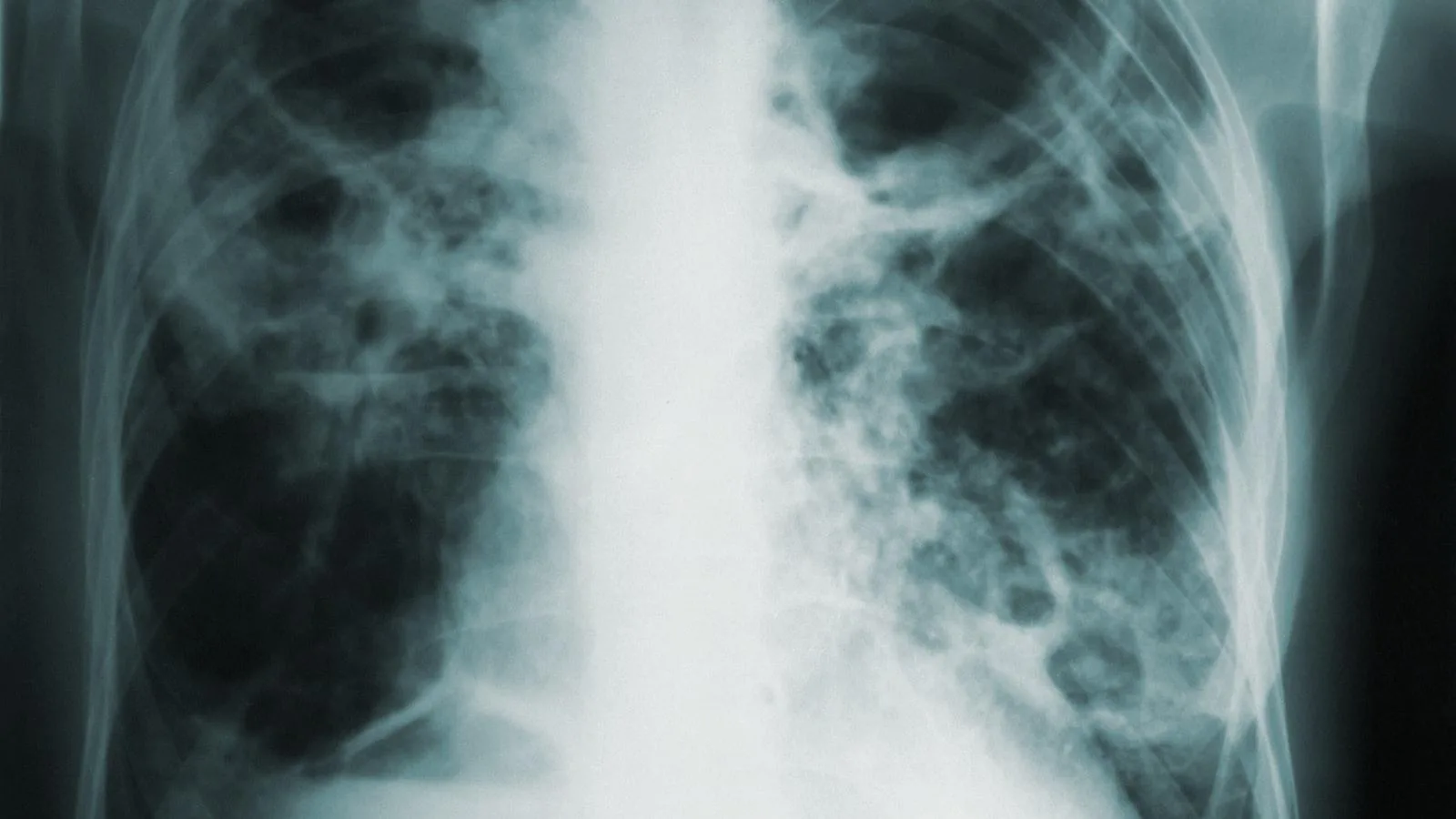 What Is Pulmonary Lobectomy: Overview, Benefits, And Expected Results ...