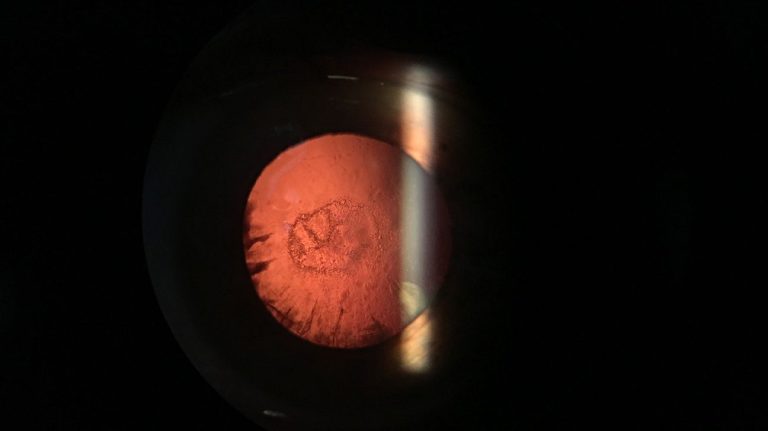 Posterior Subcapsular Cataract: Causes, Symptoms, Treatment – Adoctor