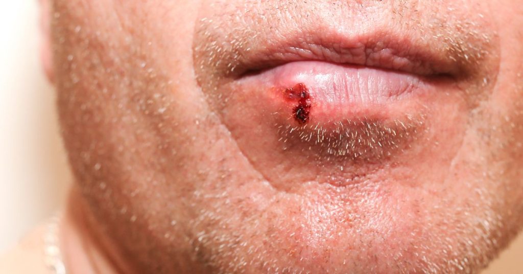 Creon Side Effects: What They Are And How To Manage Them - Adoctor